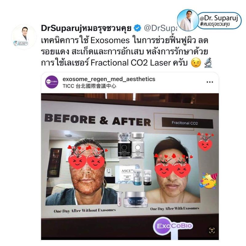 [หมอรุจชวนคุย Dr. Suparuj ผมผิวสิวหลุมสิวแผลเป็น] 📍 เทคนิคการใช้ Exosomes ในการช่วยฟื้นฟูผิว 📍 ...
