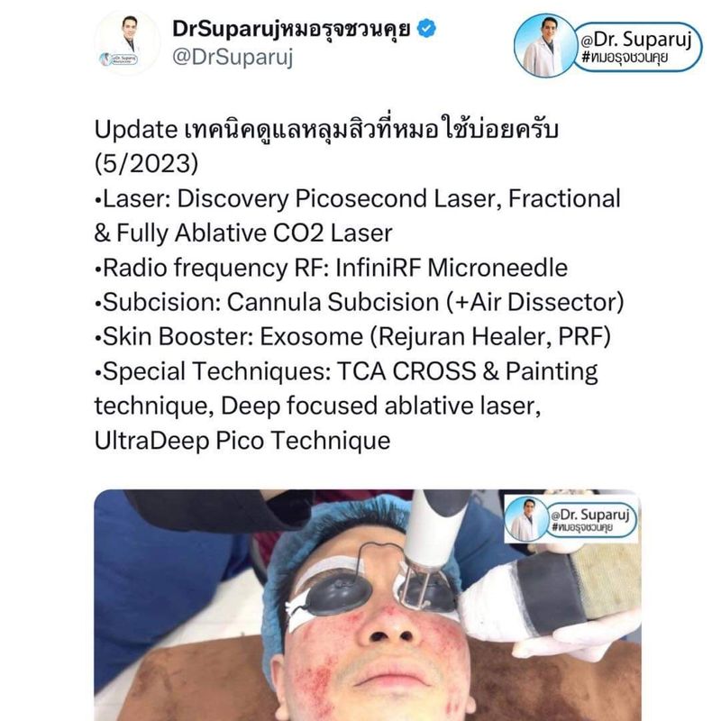 [หมอรุจชวนคุย Dr. Suparuj ผมผิวสิวหลุมสิวแผลเป็น] 📍Update เทคนิคดูแลหลุมสิวที่หมอใช้บ่อยครับ (5/ ...
