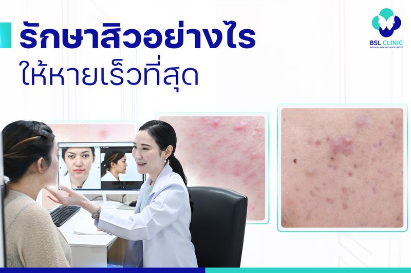 [BSL Clinic] 👨‍🔬 รักษาสิวอย่างไร ให้สิวหายเร็วที่สุด 👨‍🔬 ปรึกษา ...