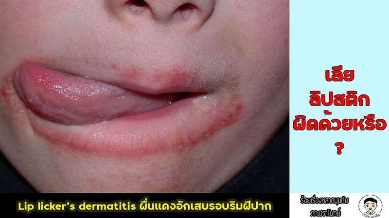 [ร้อยเรื่องหลากมุมกับ ภก.ปราโมทย์] Lip licker’s dermatitis ผื่นแดงอักเสบรอบริมฝีปาก สารภาพตามตรง ...