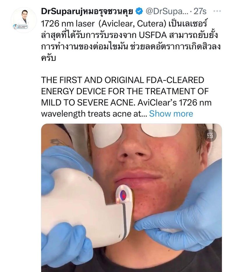 [DeMed Clinic ดูแลผิวสิวแผลเป็นหลุมสิวเส้นผม] 🔬1726 nm laser (Aviclear ...