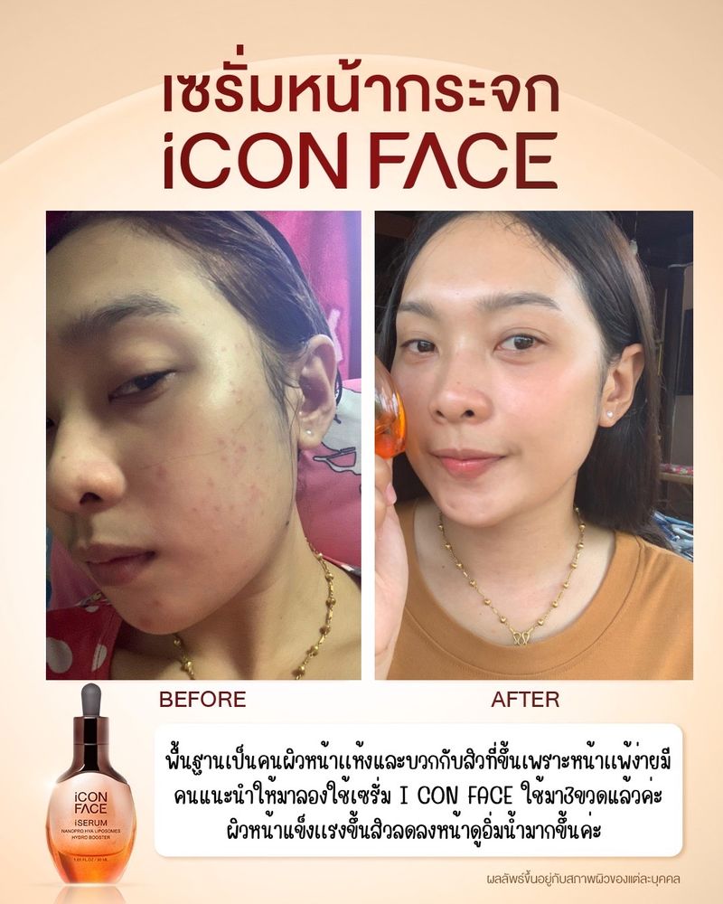 [Mike The Icon] iConFace iSerum เซรั่มที่มาแรงที่สุดณตอนนี้ เซรั่ม ...