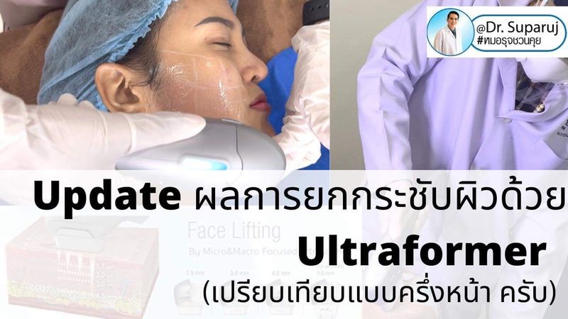 [หมอรุจชวนคุย Dr. Suparuj ผมผิวสิวหลุมสิวแผลเป็น] 📍 Update ผลการยกกระชับผิวด้วย Ultraformer ...