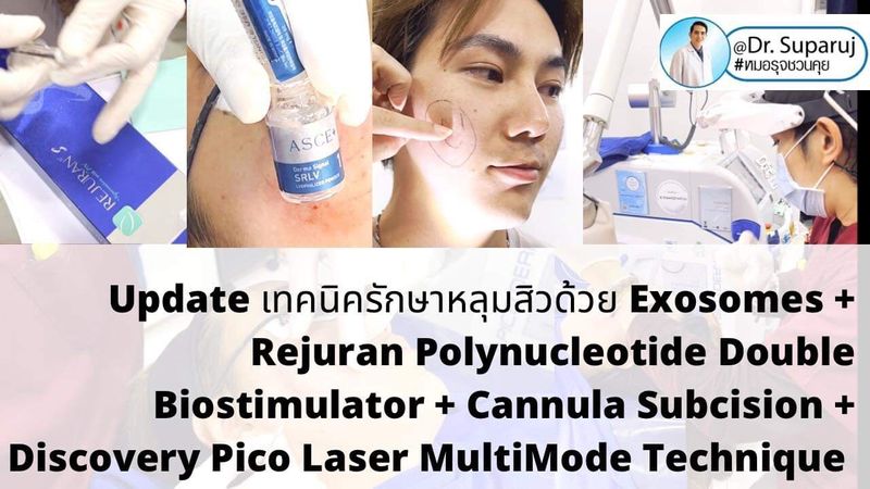 [หมอรุจชวนคุย Dr. Suparuj ผมผิวสิวหลุมสิวแผลเป็น] 📍Update เทคนิคดูแลหลุมสิว 📍Update เทคนิคดูแล ...