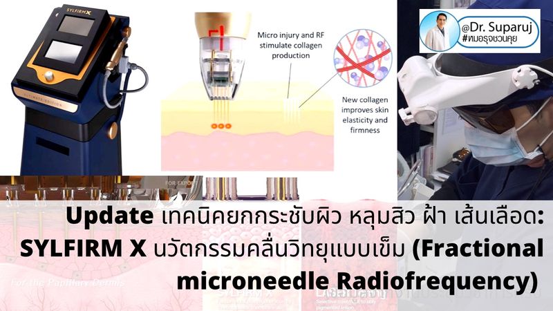 [หมอรุจชวนคุย Dr. Suparuj ผมผิวสิวหลุมสิวแผลเป็น] 📍Update เทคนิคยกกระชับผิว หลุมสิว ดูแลปัญหา ...