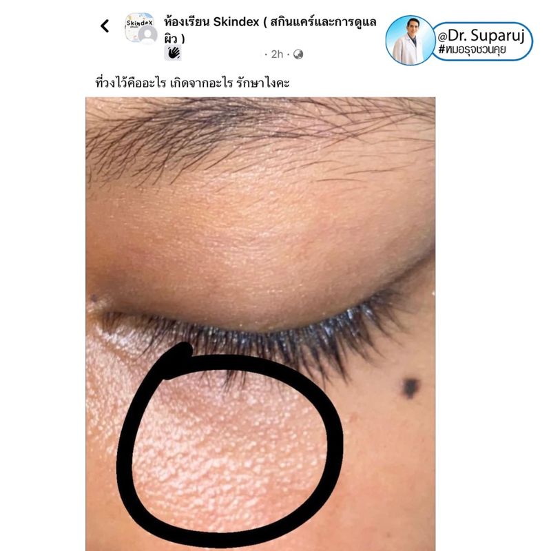 [หมอรุจชวนคุย Dr. Suparuj ผมผิวสิวหลุมสิวแผลเป็น] เป็นต่อมไขมันที่เด่น ...