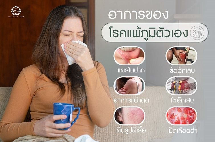 [W9 Wellness Center] อาการของ โรค SLE (Systemic Lupus Erythematosus ...