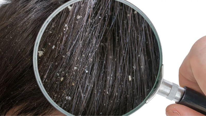 [สุขภาพ ] doctor at home: รังแค (Dandruff/Seborrhea/Pityriasis capitis ...