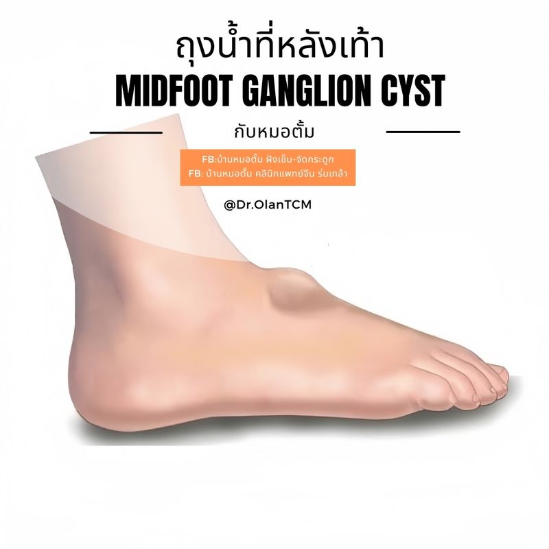 [บ้านหมอตั้ม] โรคถุงน้ำที่หลังเท้า (midfoot ganglion cyst) โรคถุงน้ำที่ ...