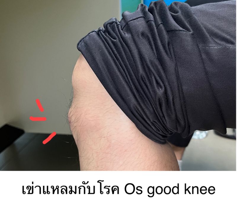 [หมอเฝิง แพทย์แผนจีน] โรคเข่าแหลม โรคเข่าแหลม เข้าปูด หรือปุ่มกระดูก ...