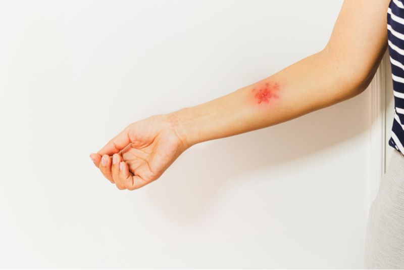 [โรงพยาบาลเพชรเวช] งูสวัด ภัยแฝงที่อันตรายถึงชีวิต โรคงูสวัด เป็นโรคที่ ...