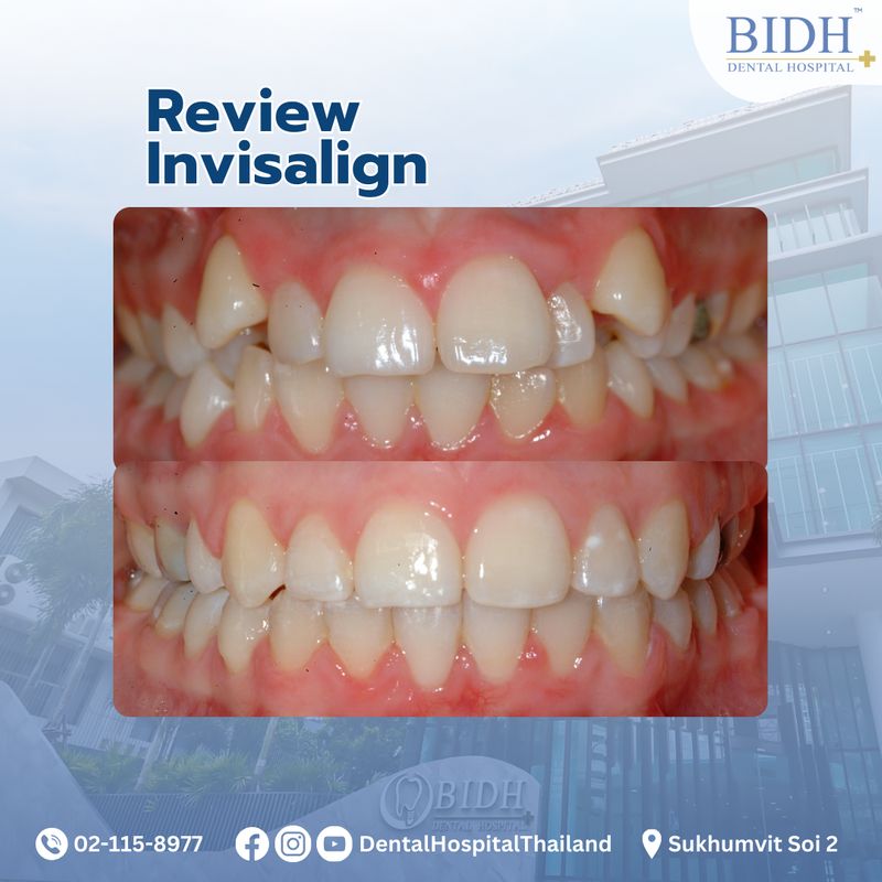 [Bangkok international dental hospital] ปรับการเรียงตัวของฟันให้สวยงาม เพิ่มประสิทธิภาพในการกัด ...