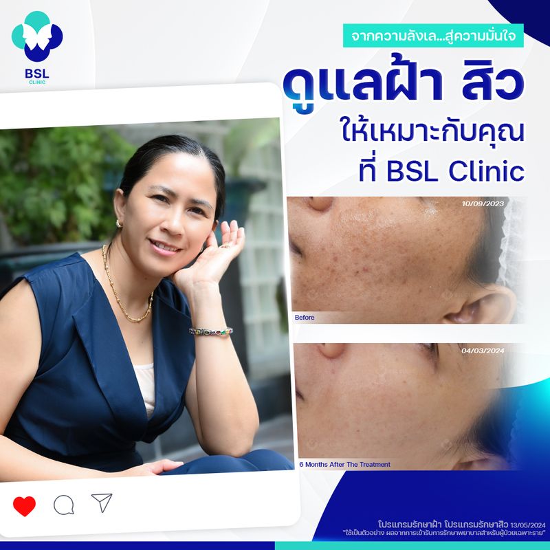 [BSL Clinic] "จากความลังเล…สู่ความมั่นใจ ดูแลฝ้า สิว ให้เหมาะกับสภาพผิว ...