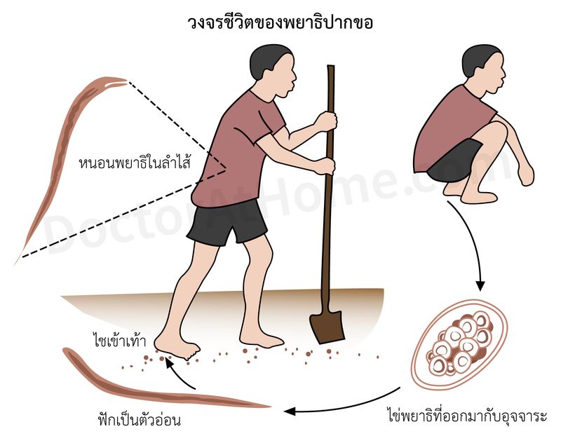 [สุขภาพ ] ตรวจอาการเบื้องต้นด้วยตนเอง: โรคพยาธิปากขอ (Hook worm disease ...