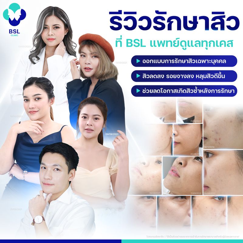 [BSL Clinic] "เพราะ ""สิว"" ไม่ได้มีแค่สาเหตุเดียว การดูแลจึงต้อง ...