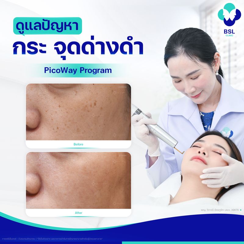 [BSL Clinic] กระตื้น กระลึก กระแดด รักษากระอย่างไร ให้ดูจางลง? Program PicoWay Laser เทคโนโลยี ...