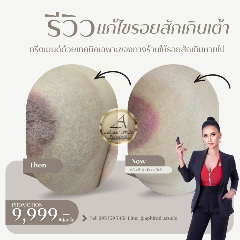 [Areola Pigmentation & Realistic Nipple PMU] แก้ไขรอยสักเกินเต้า คุณ ...