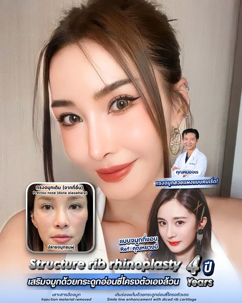 [Dr. Jaray Cosmetic Surgery] 4 Years After Rhinoplasty — When Natural ...